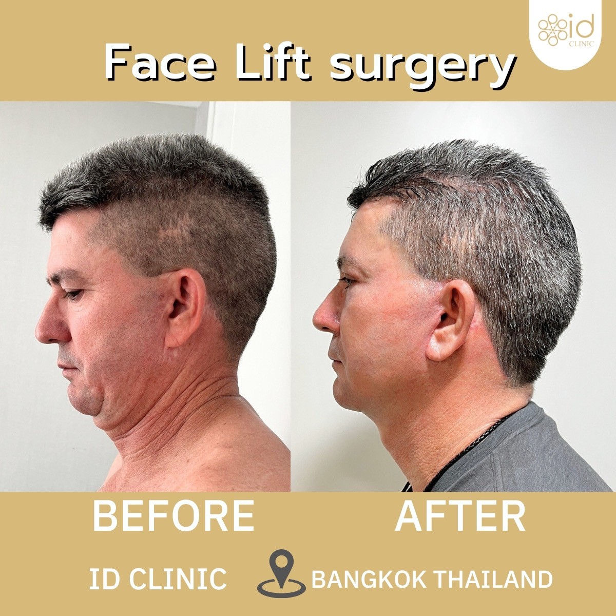 Facelift Surgery | Top Med World