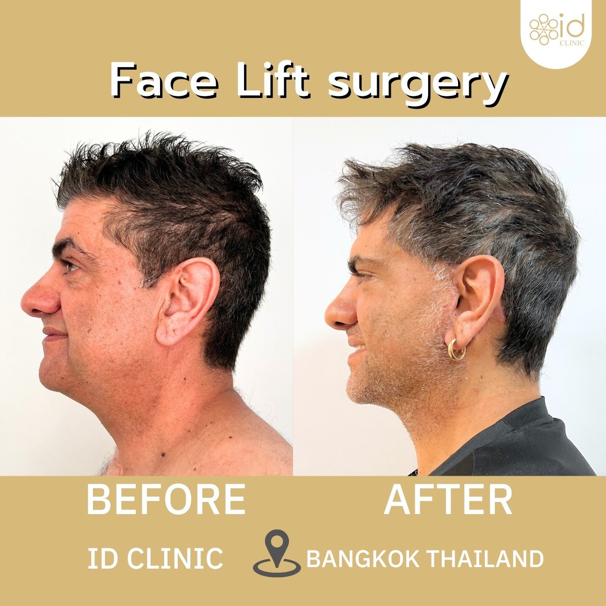 Facelift Surgery | Top Med World